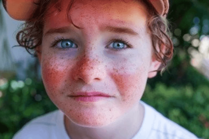 Sun Poisoning Can Kill You: Symptoms and Causes - MetroYak